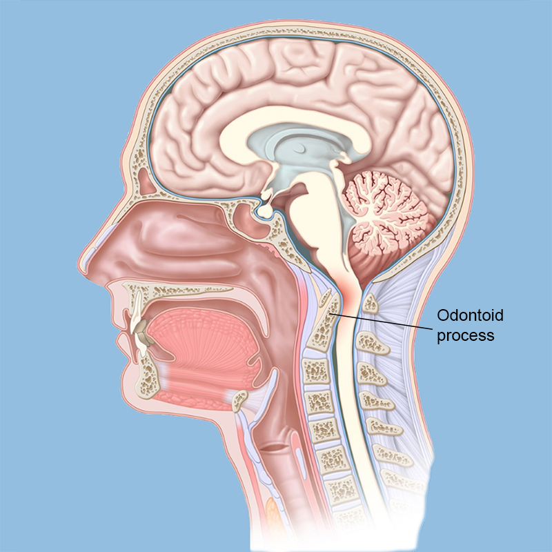 Craniocervical Junction Disorders | Weill Cornell Brain and Spine Center